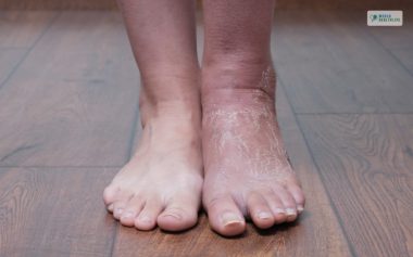 Charcot Foot 101: Top 6 Ways To Prevent It And More!